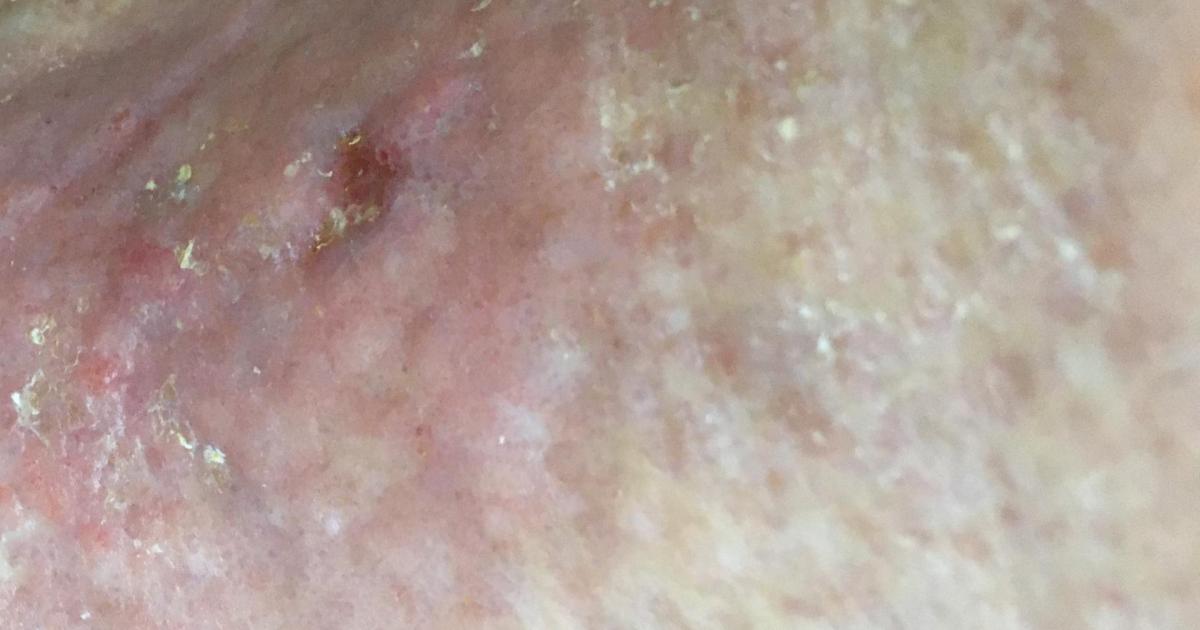 Bércový vřed (Ulcus cruris venosum) | Dermaweb